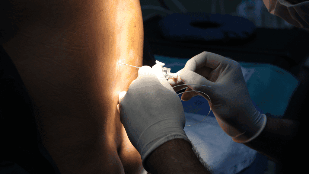 Epidural Steroid Injections: How They Work for Chronic Back and Neck ...